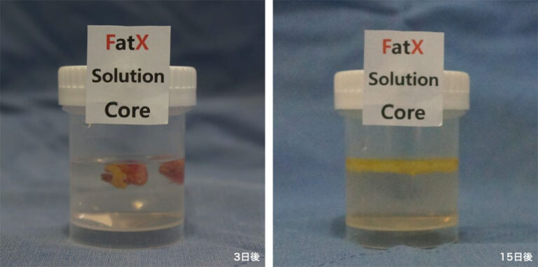 FatX core（脂肪溶解注射） | 世田谷 二子玉川の美容外科・美容皮膚科【あきこクリニック】
